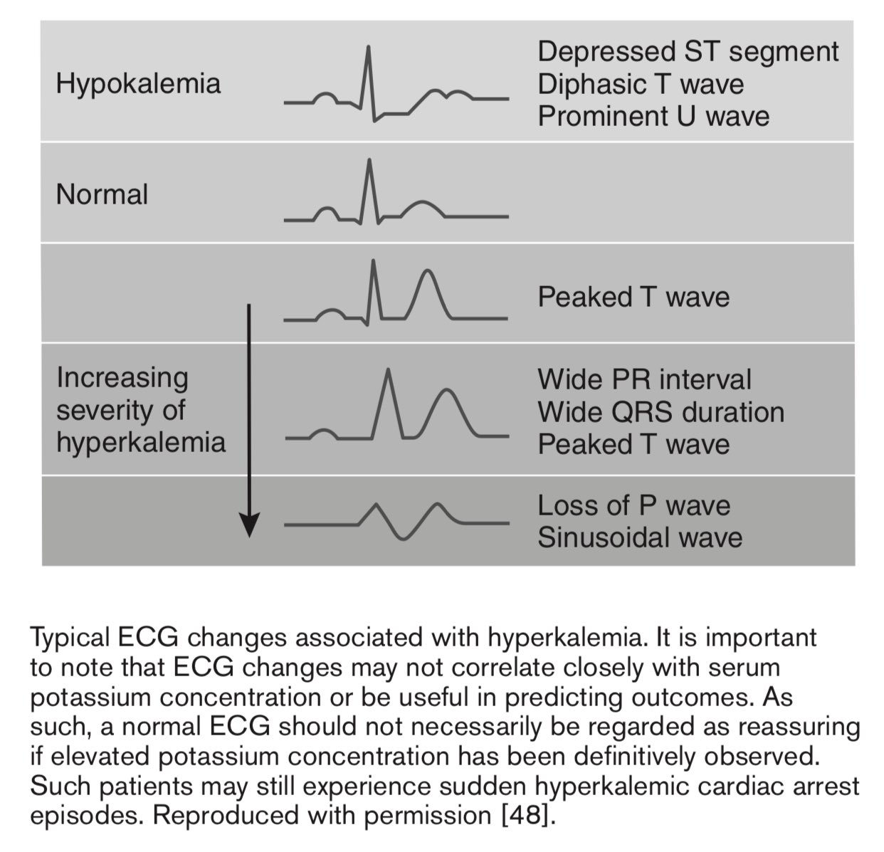 Typical ECG Changes Associated With Hyperkalemia GrepMed Typical ECG Changes Associated With Hyperkalemia GrepMed