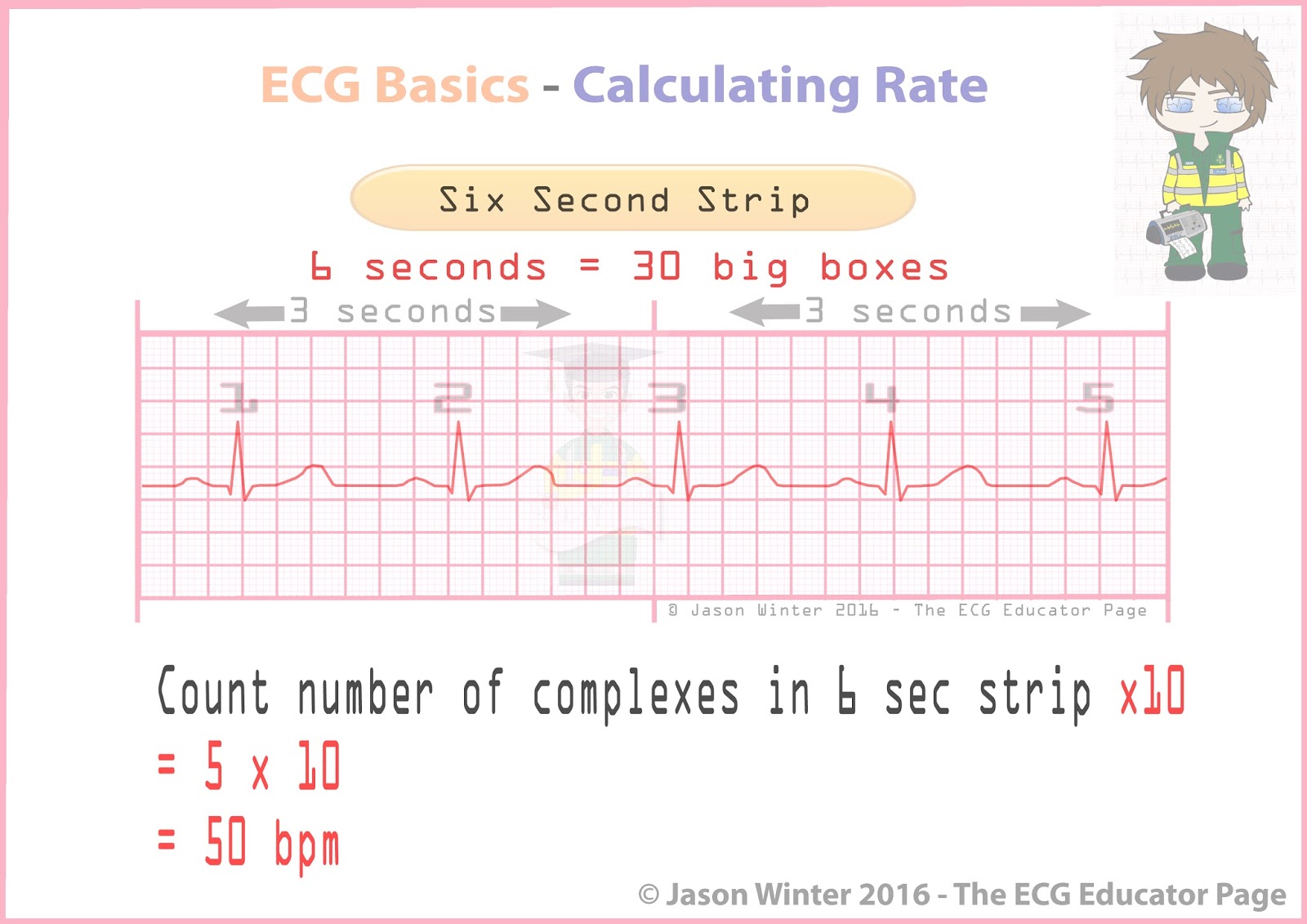 How To Calculate Heart Rate From Ecg With Irregular Rhythm Haiper
