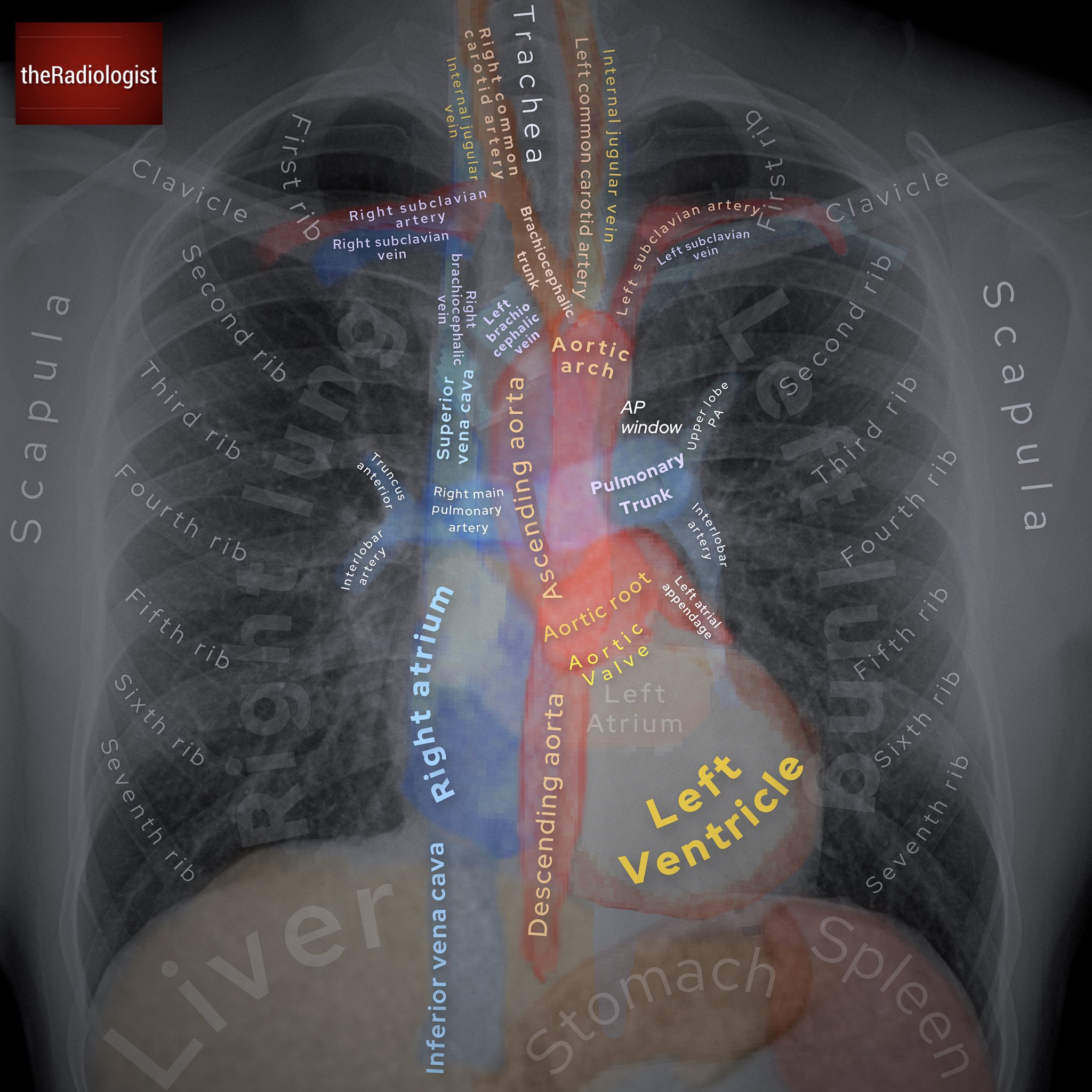 Labeled Chest X Ray Anatomy By Dr Naveen Sharma GrepMed
