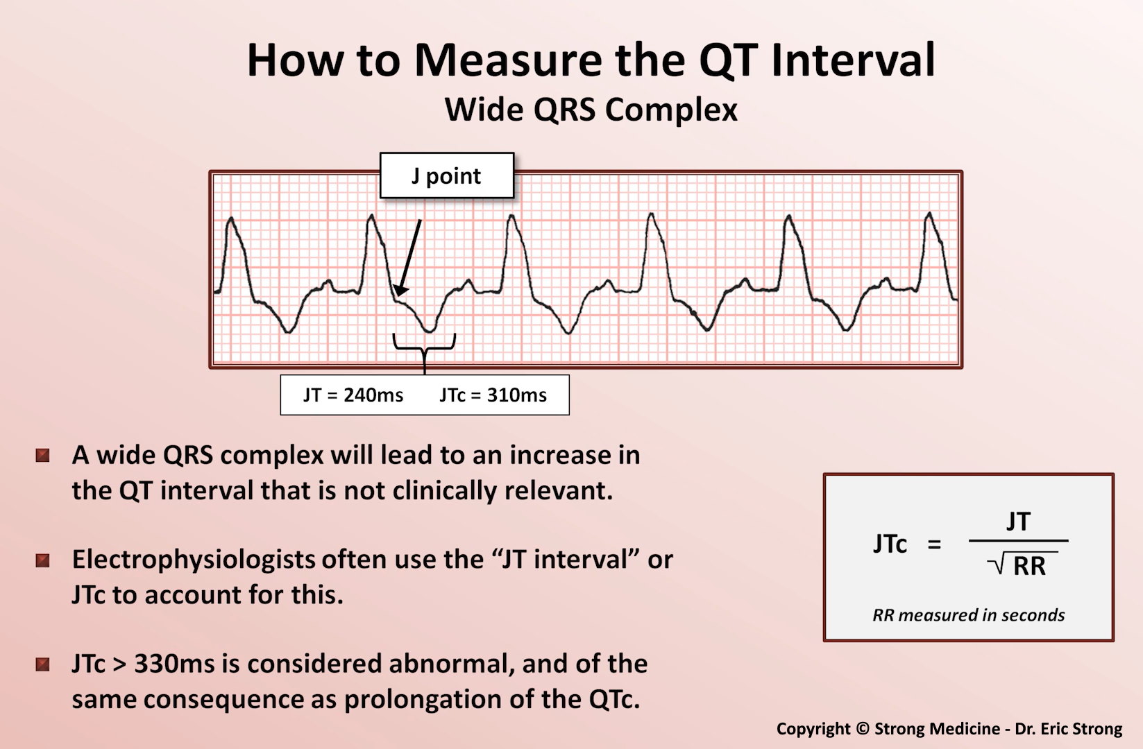 QT QTc Interval Measurement In Wide QRS Complex GrepMed