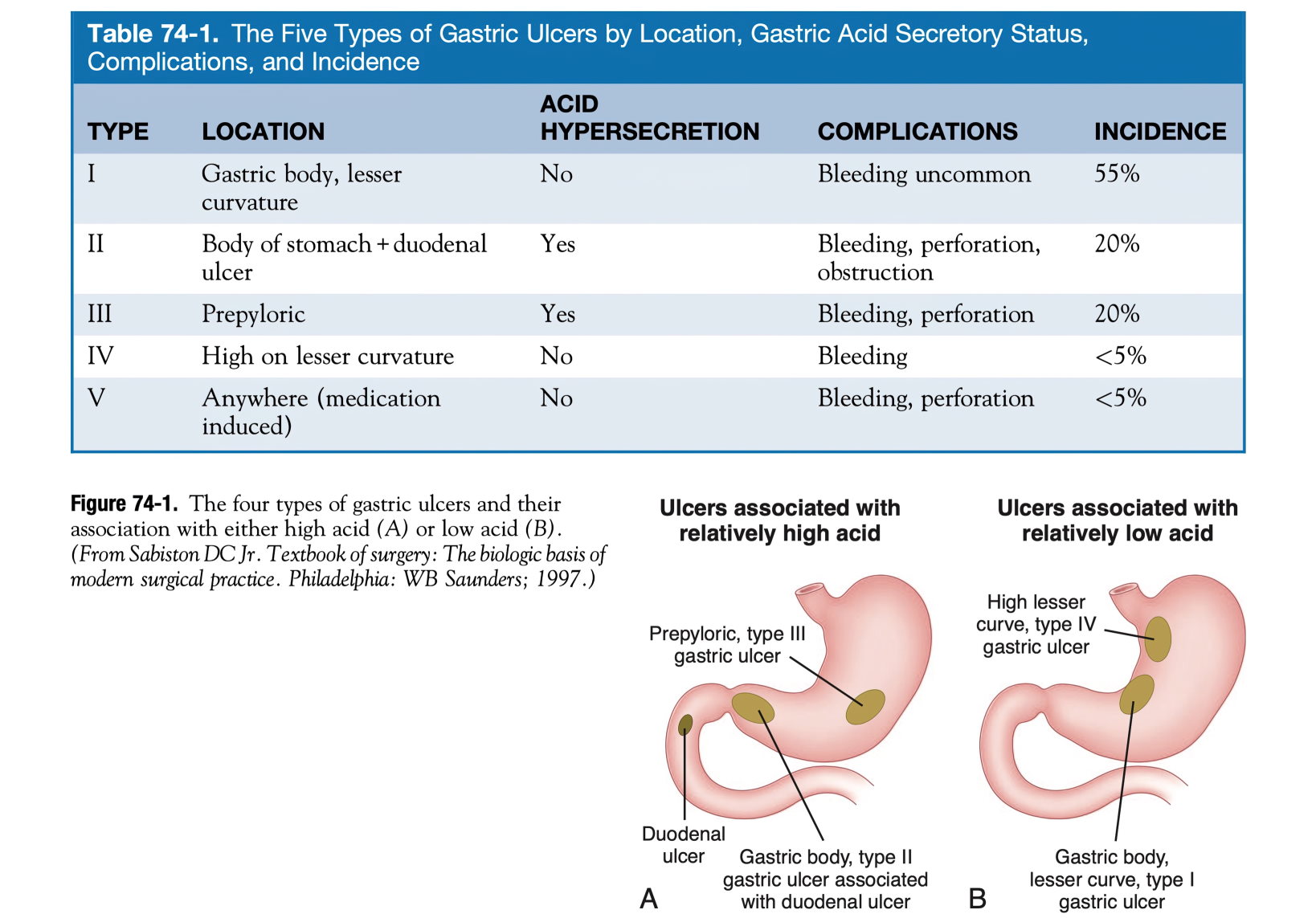 Modified Johnson Classification For Gastric Ulcers Type GrepMed