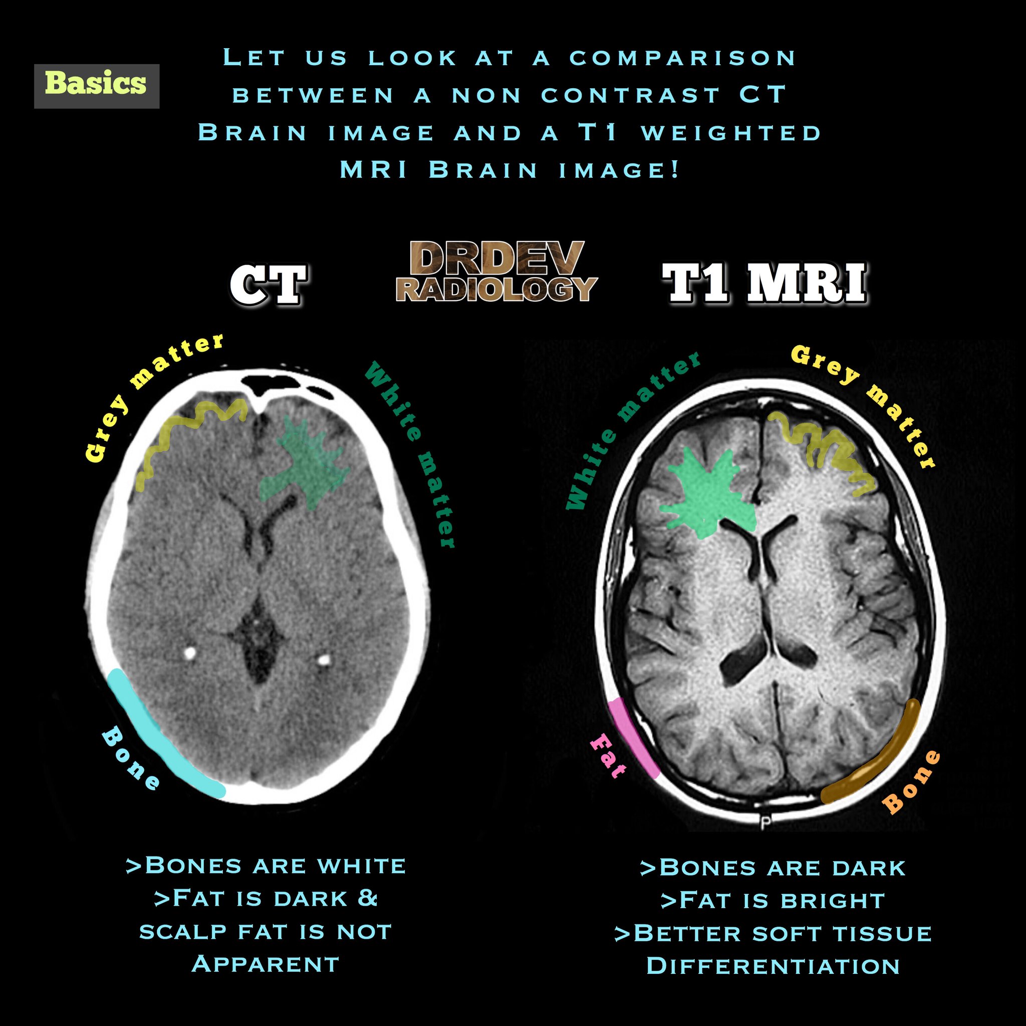 CT Vs T1 MRI CT Head Bones Are White Fat Is GrepMed