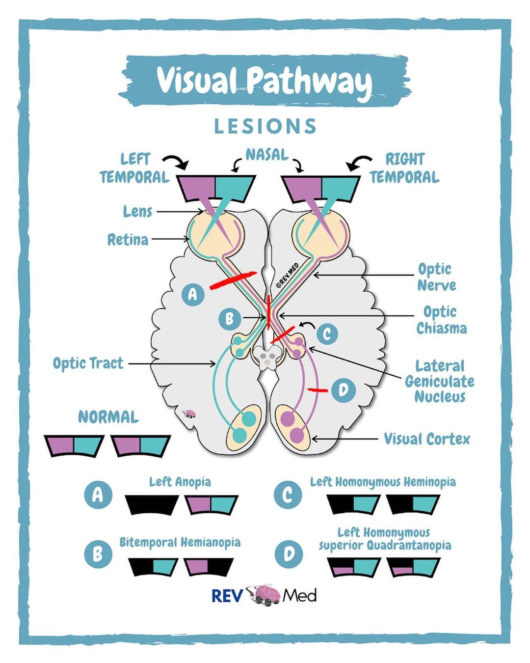 Visual Pathway Neural Lesions A Optic Nerve Left GrepMed