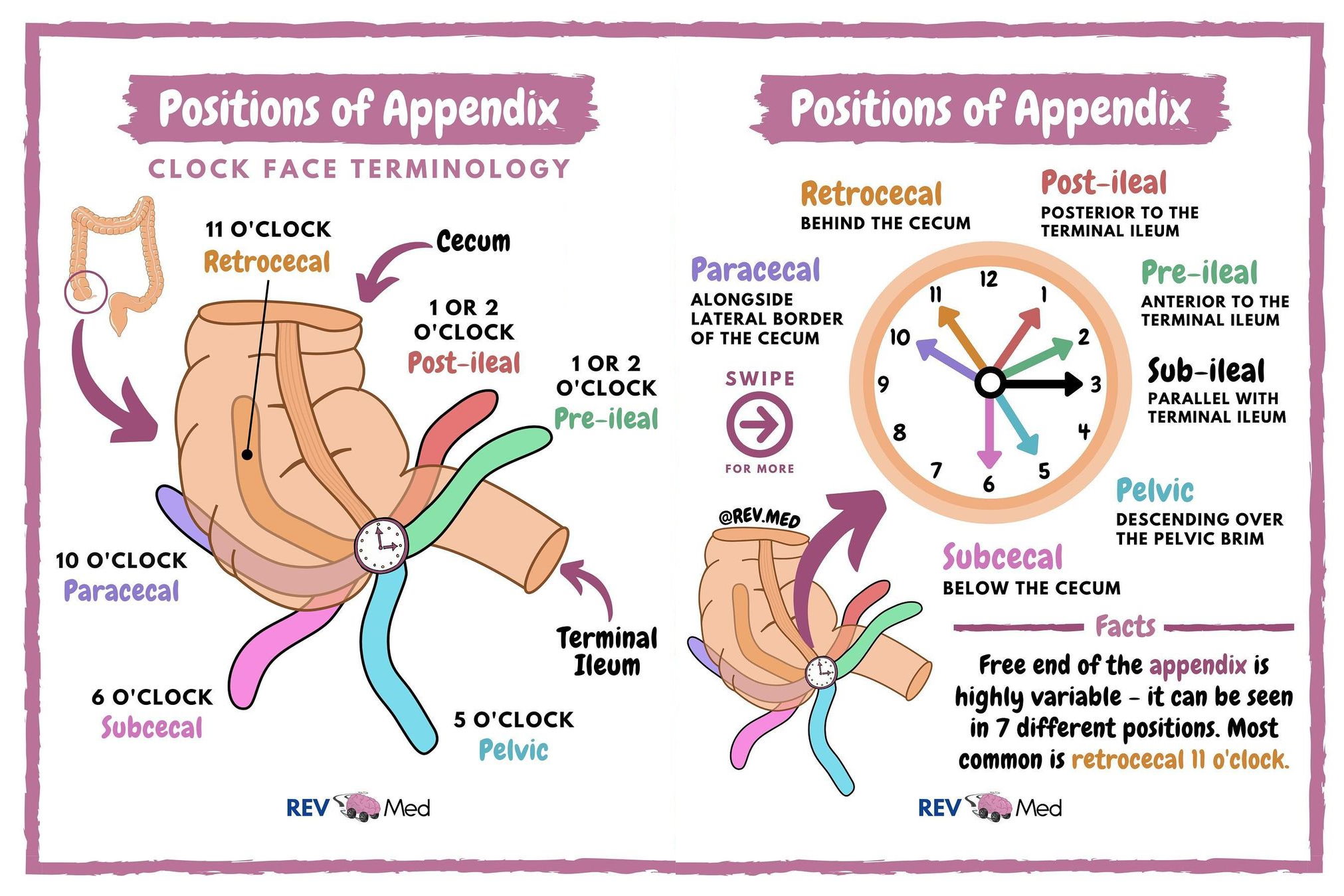 Appendix Positions Retrocecal most Common GrepMed