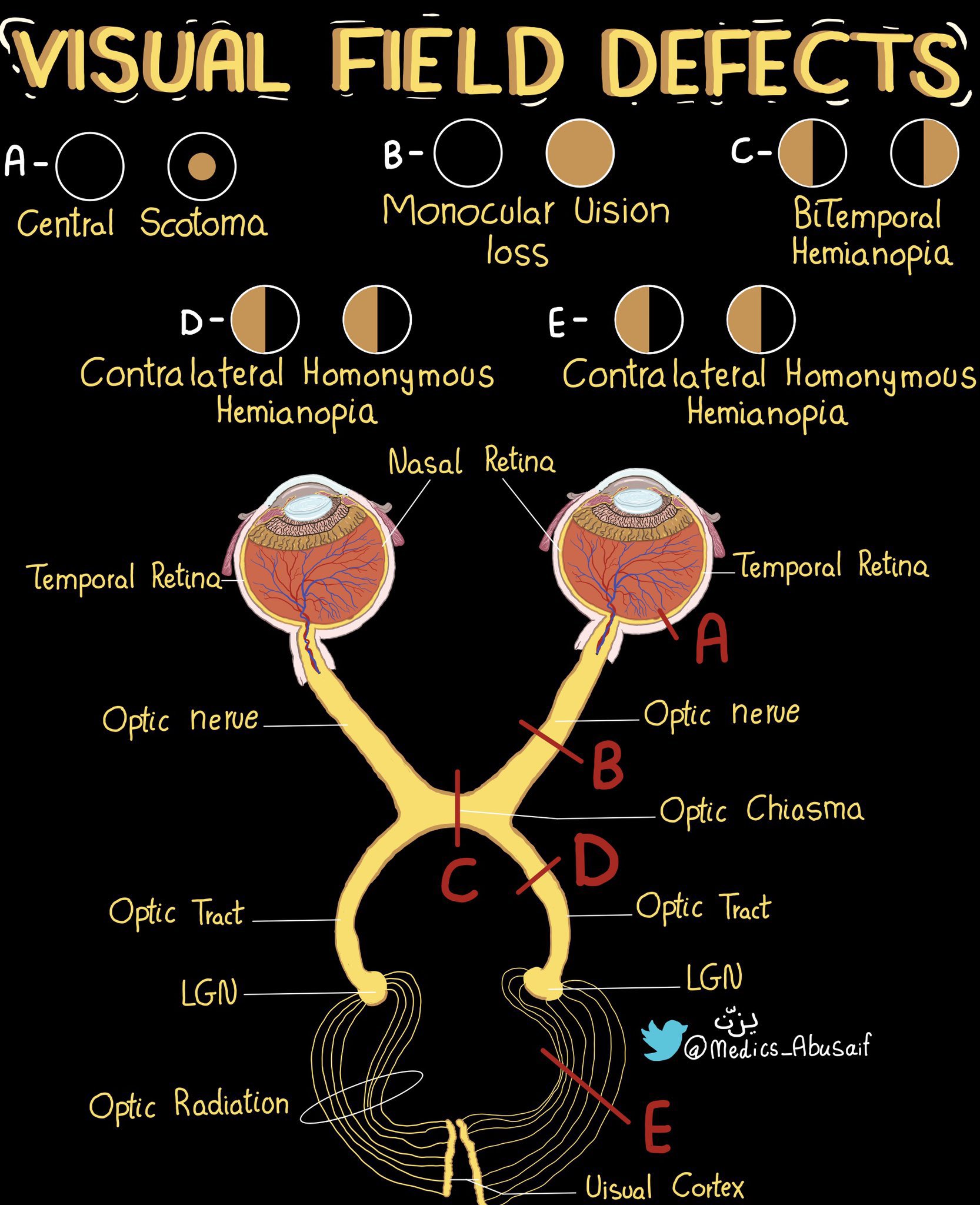 Visual field defects #visual_field_defects #medics_abusaif ... | GrepMed