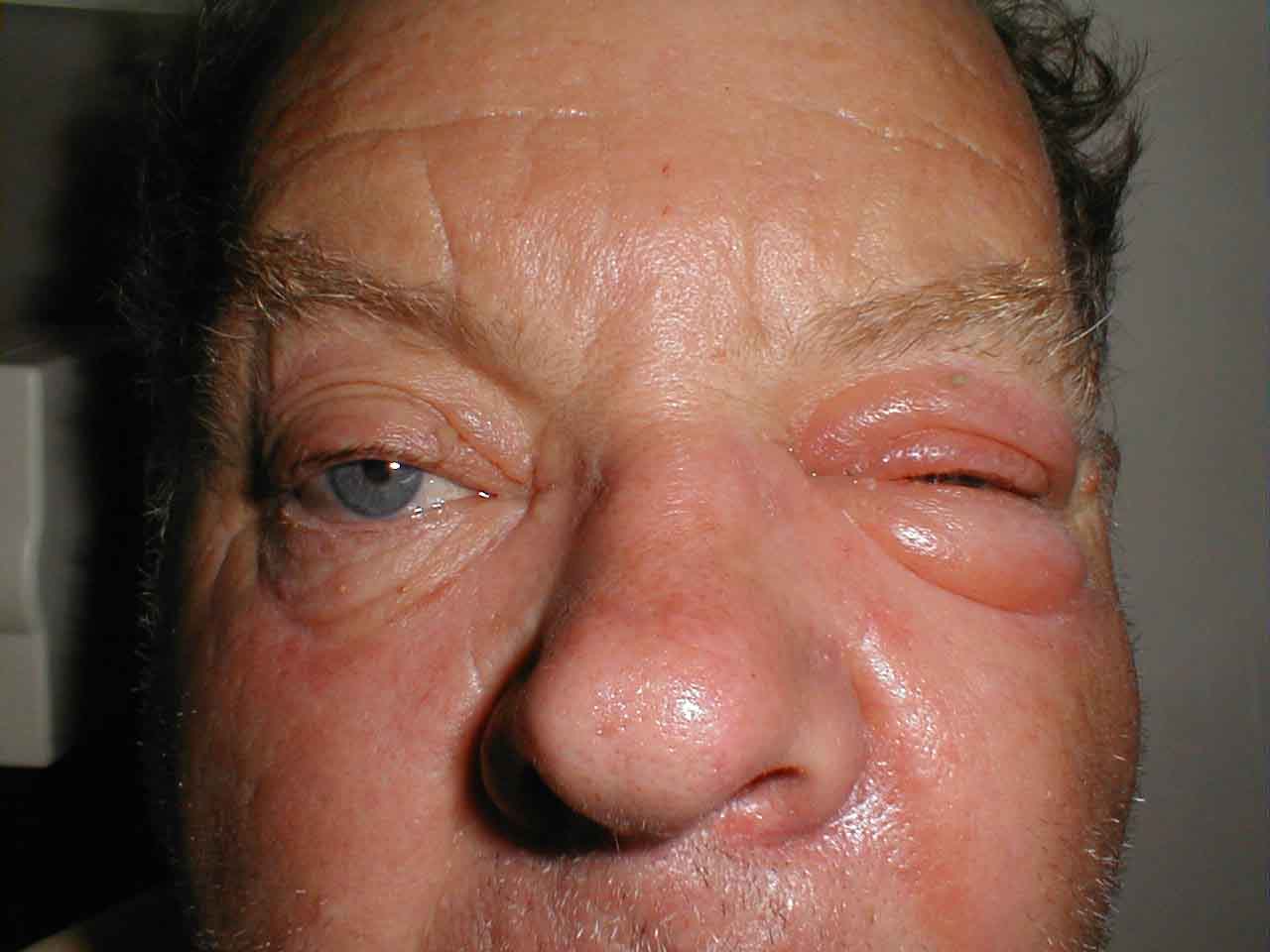 Periorbital Cellulits Note Marked Swelling And Redness GrepMed