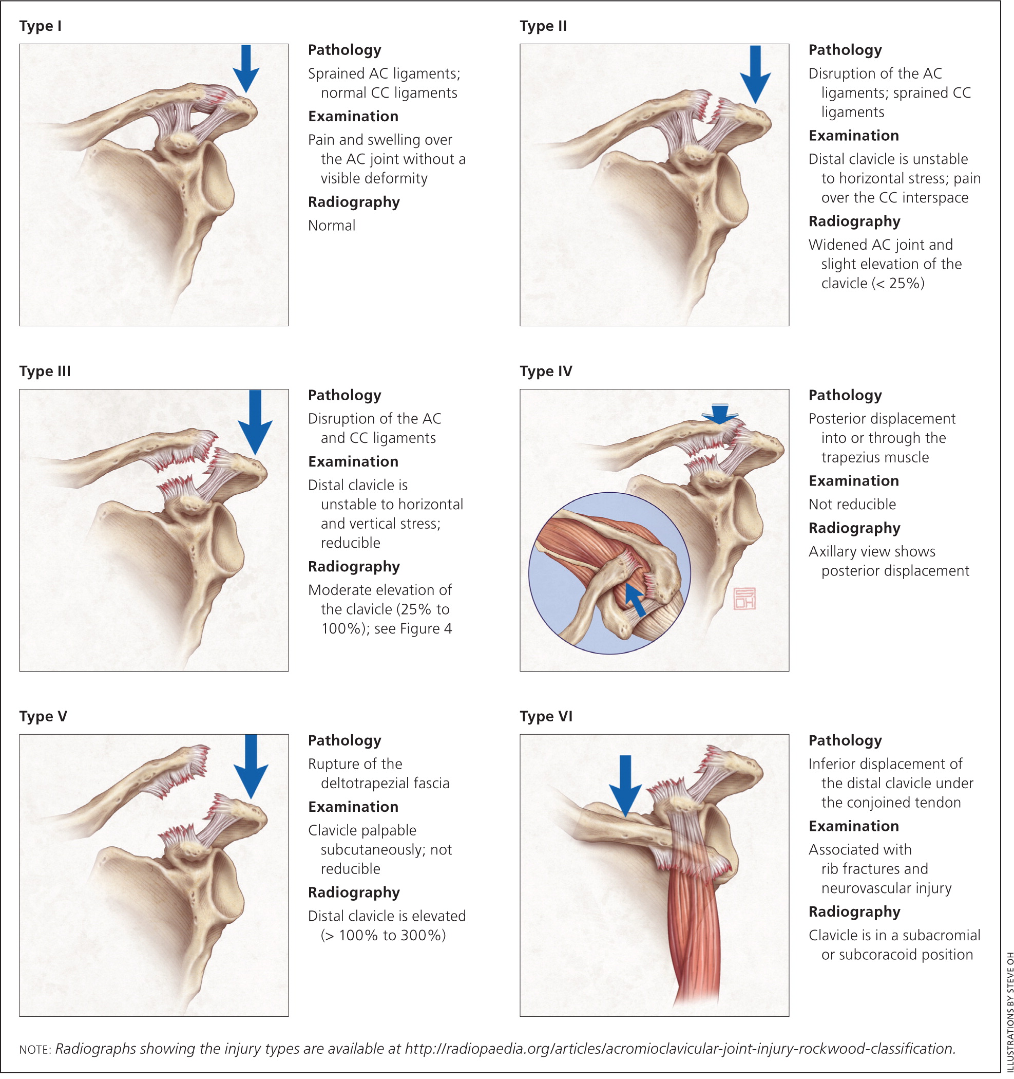 Rockwood Classification Of AC Injuries AC Acromioclavicular