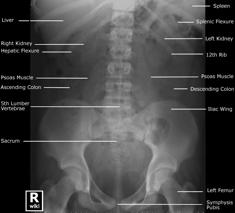 Labeled Abdominal XRay Anatomy KUB Anatomy Radiology GrepMed