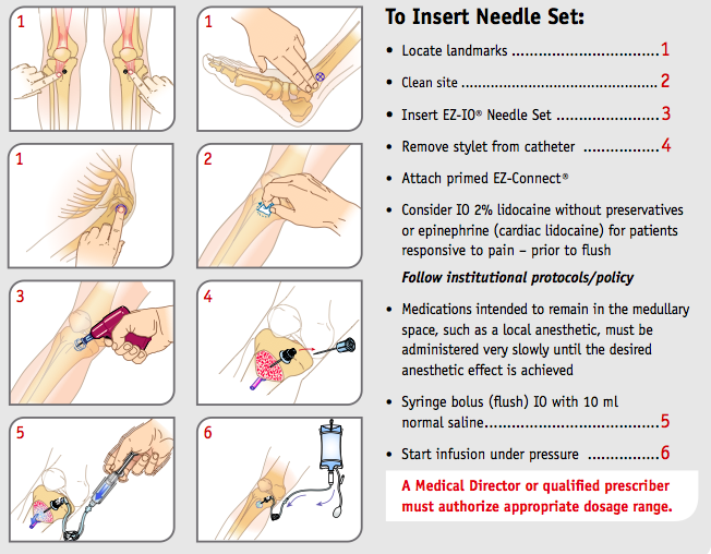 Intraosseous Access Instructions 1 Locate Landmarks 2 GrepMed