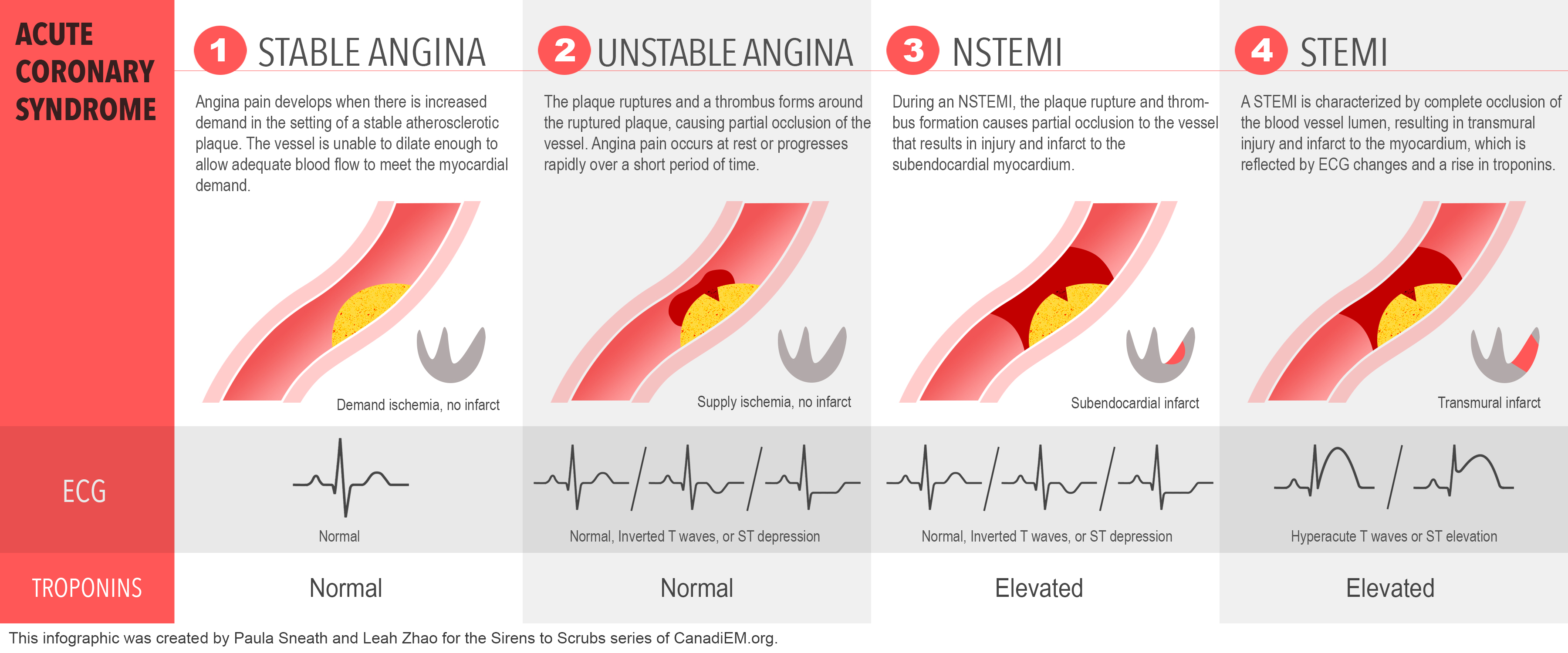 Acute Coronary Syndrome ACS Definitions Stable GrepMed
