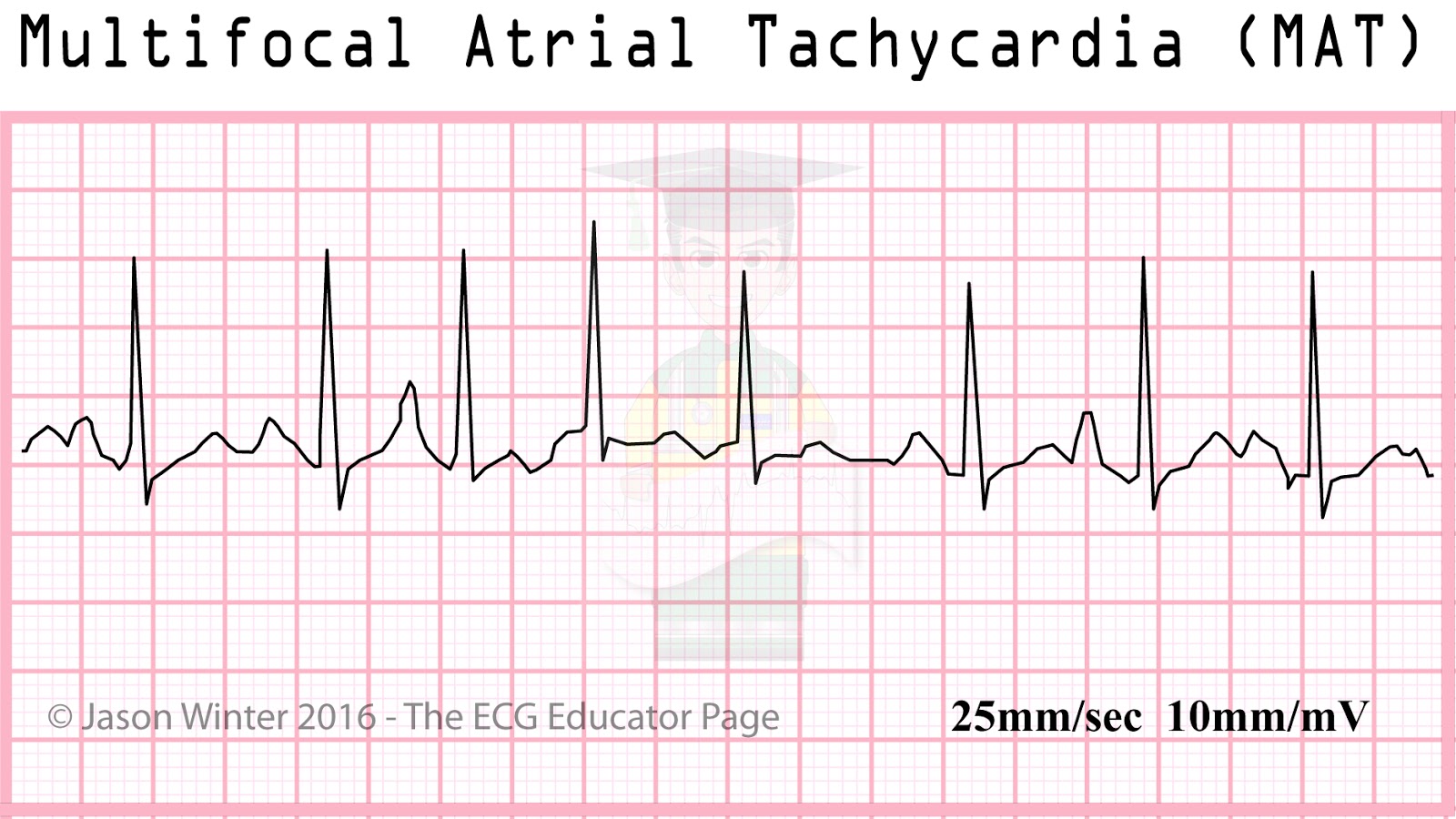 MAT Multifocal Atrial Tachycardia Clinical Cardiology GrepMed