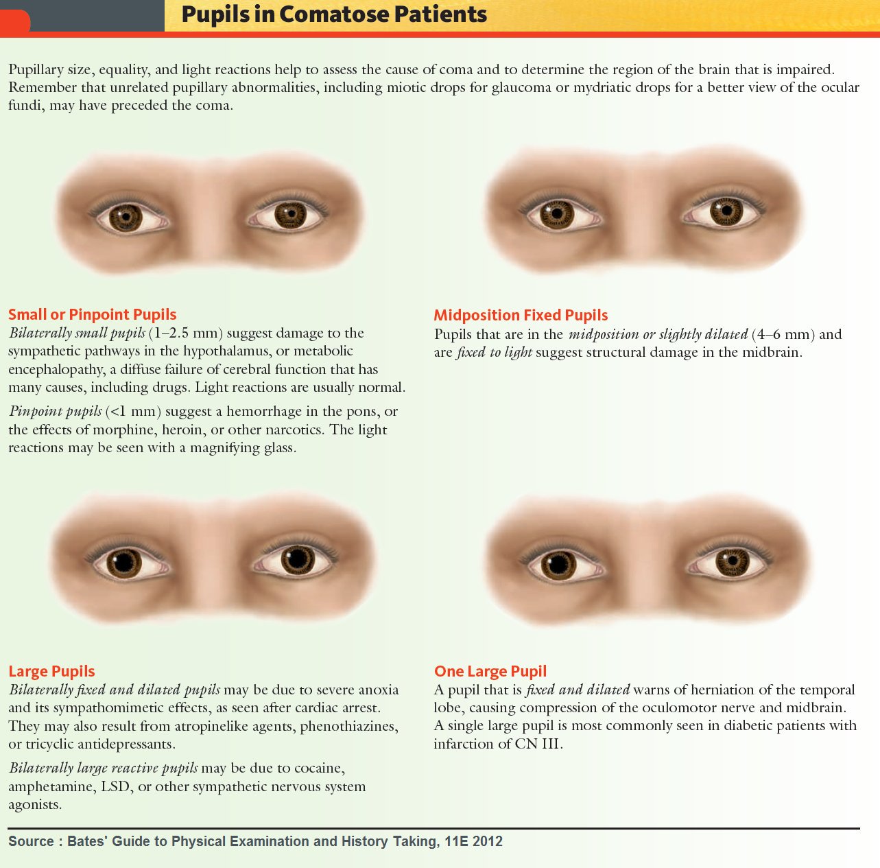 Abnormal Pupils