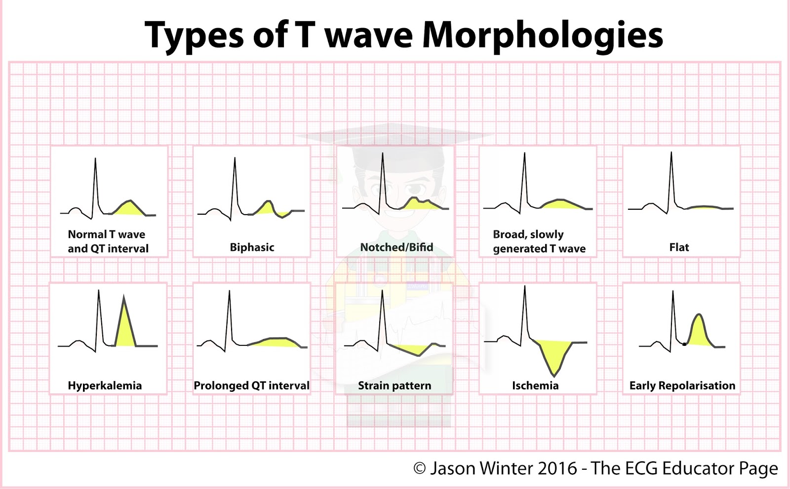Types Of T wave Morphologies Cardiology MedStudent GrepMed