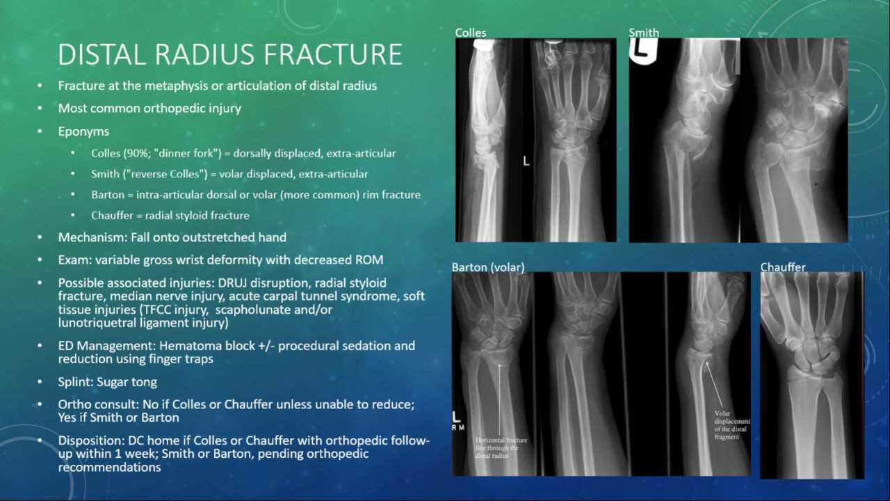 Colles Vs Smith Fracture Cloudshareinfo Colles Vs Smith Fracture Cloudshareinfo