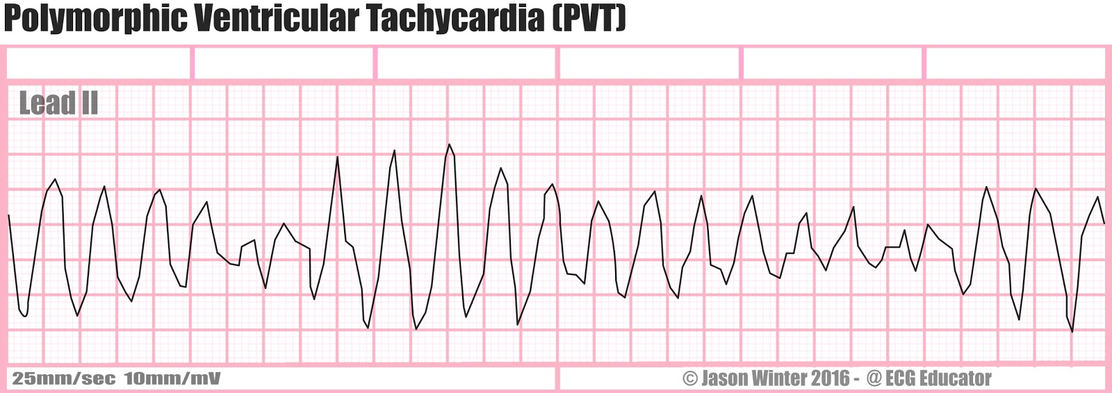 Clinical MedStudent Cardiology EKG PVT Polymorphic GrepMed Clinical MedStudent Cardiology EKG PVT Polymorphic GrepMed