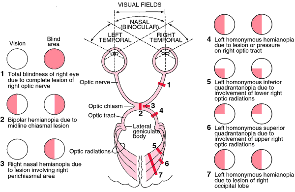 Visual Field Pathways And Deficits 1 Total Blindness GrepMed